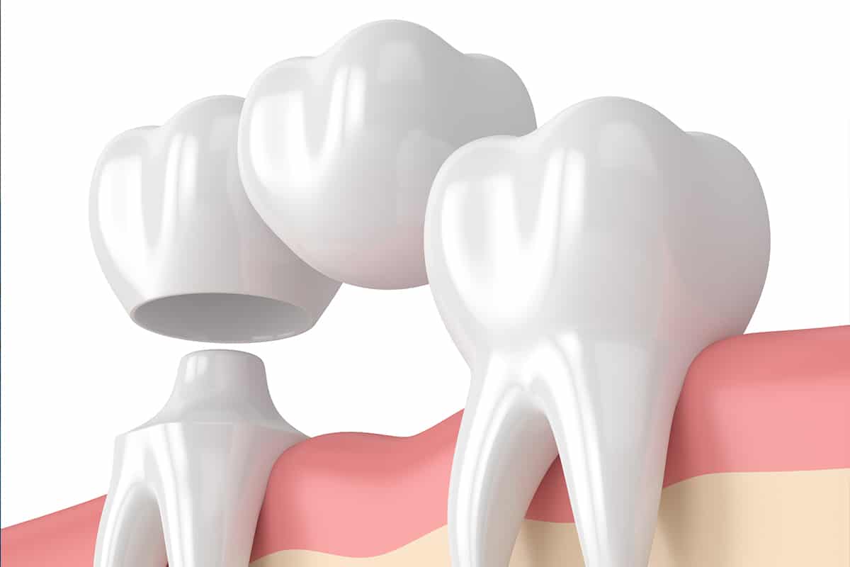What Are Fixed Bridges? | Temple, TX | Fairbanks Dental